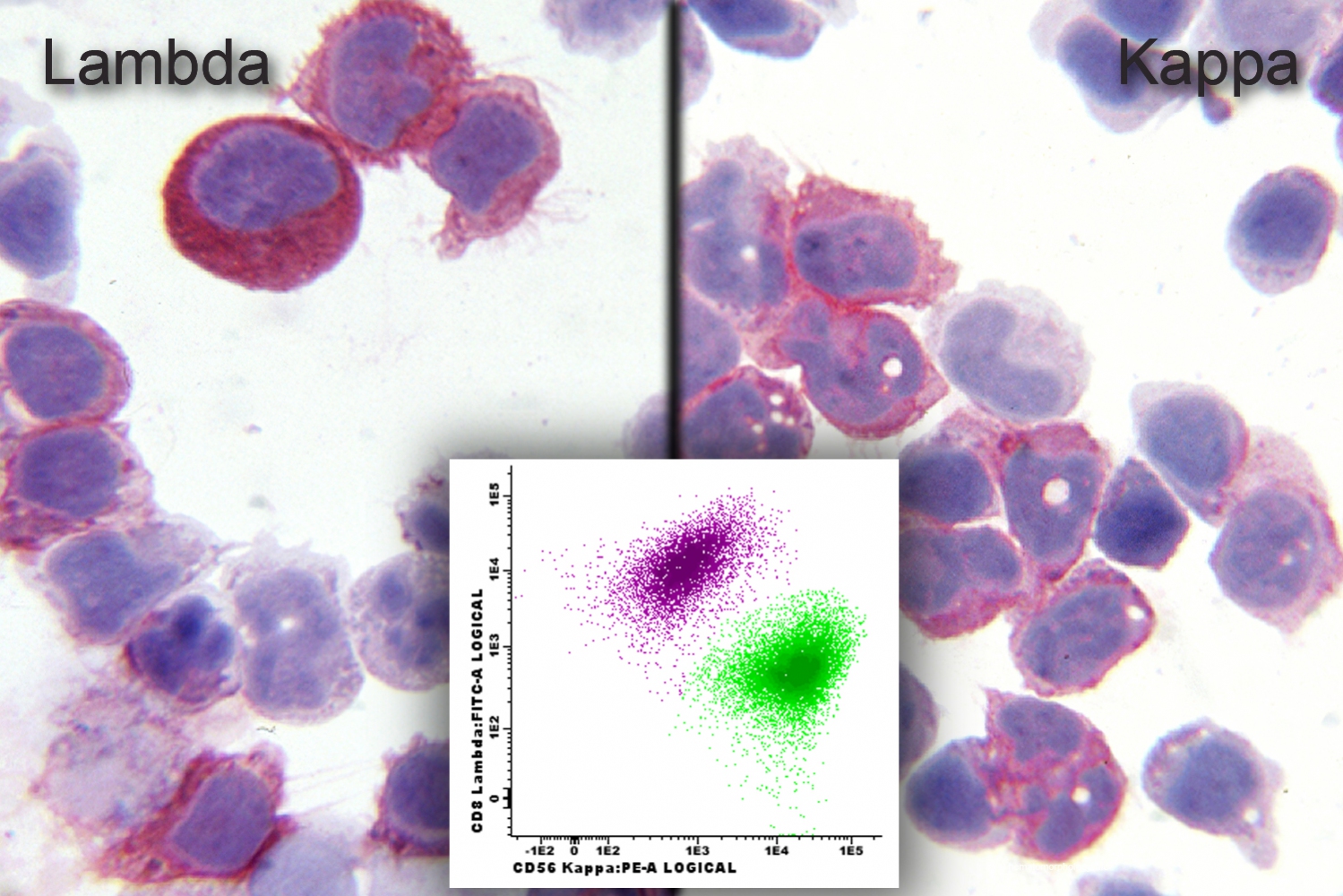 persistent polyclonal B-cell lymphocytosis (PPBL) - Hematomorphology, a ...