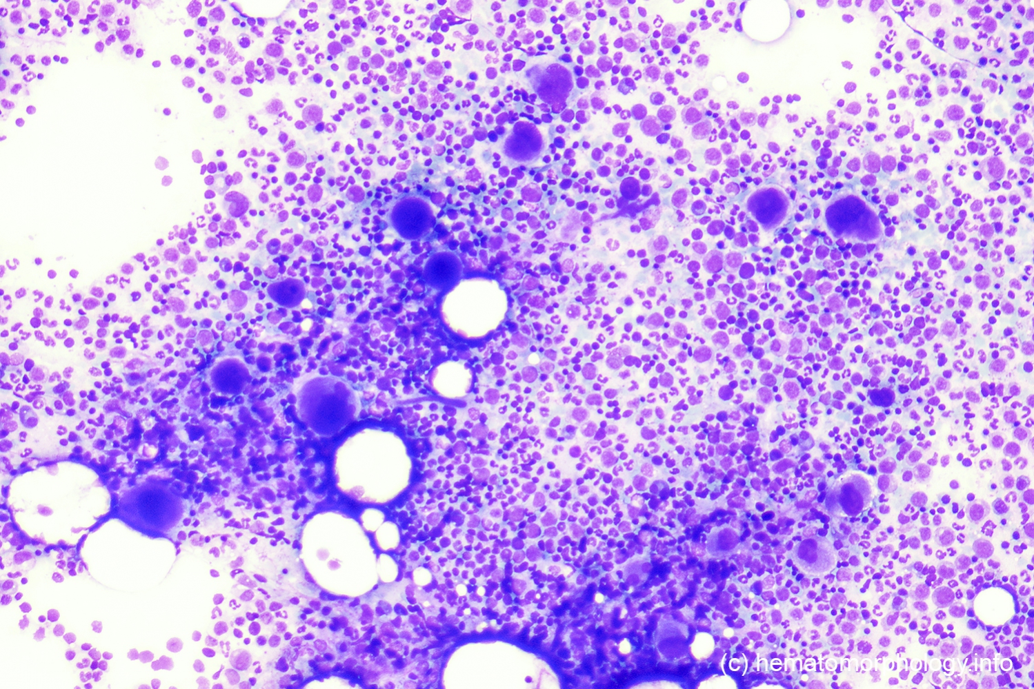Polycythemia Vera (PV) - Hematomorphology, a databank / imagebank for ...