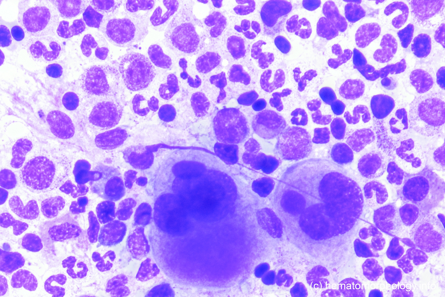 Polycythemia Vera (PV) - Hematomorphology, a databank / imagebank for ...