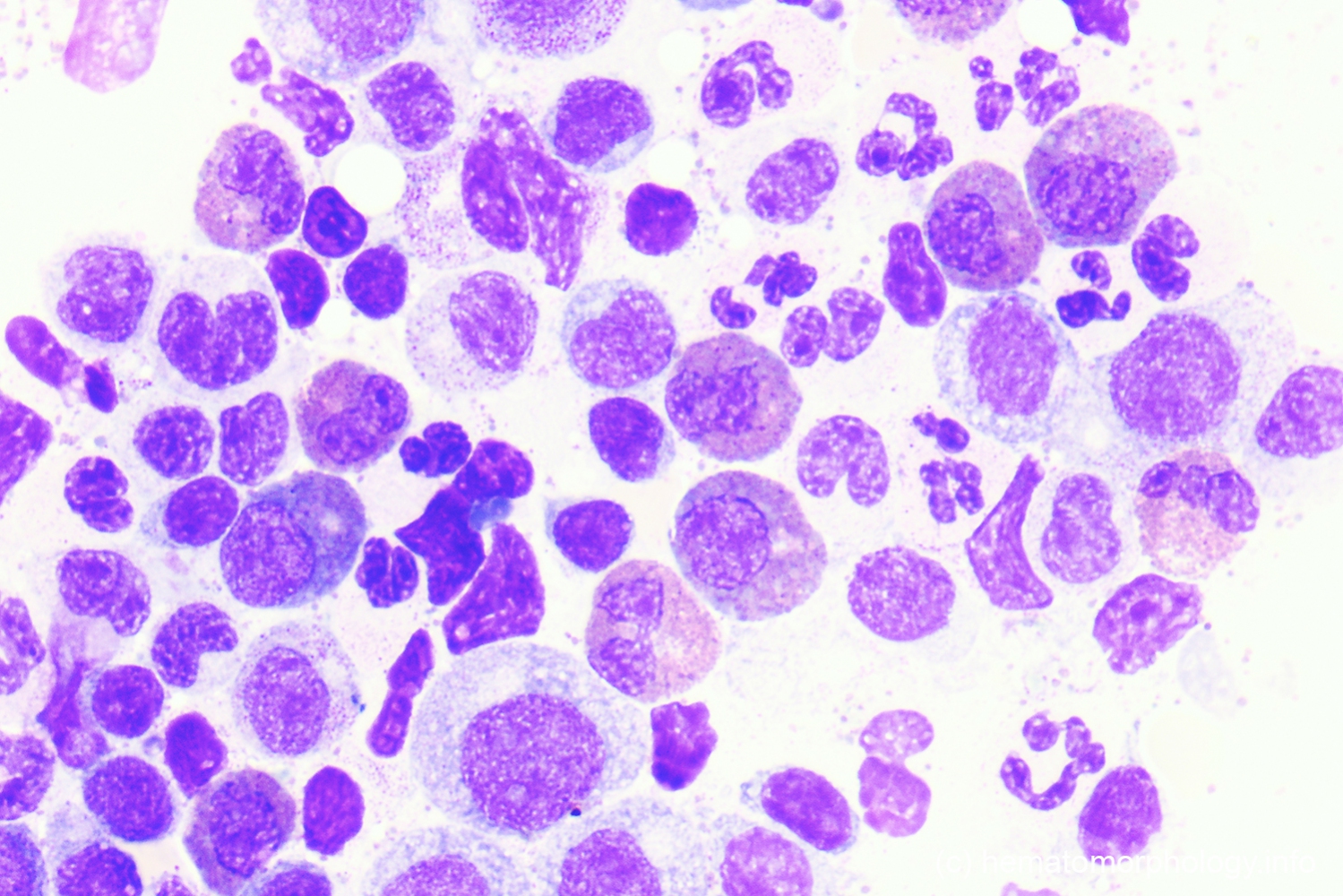 Pure red cell aplasia - Hematomorphology, a databank / imagebank for ...