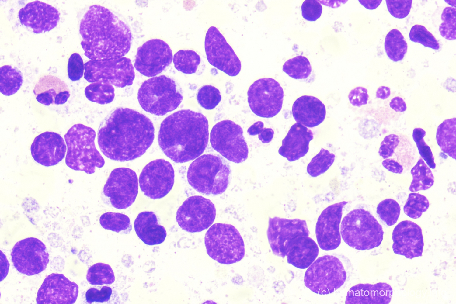 Sézary Syndrome (SS) - Hematomorphology, a databank / imagebank for ...