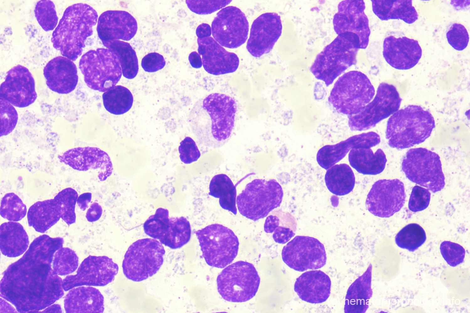 Sézary Syndrome (SS) - Hematomorphology, a databank / imagebank for ...