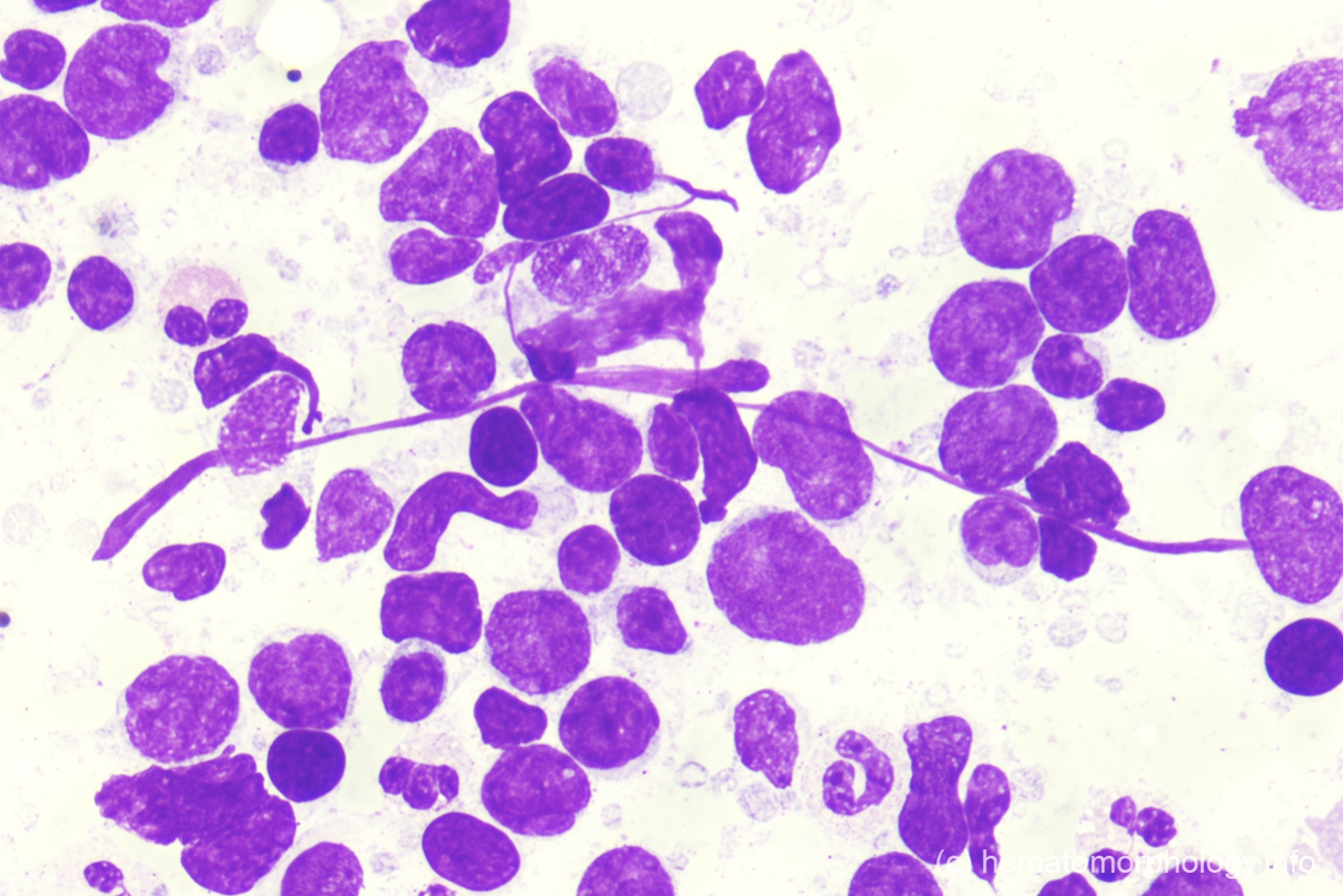 Sézary Syndrome (SS) - Hematomorphology, a databank / imagebank for ...