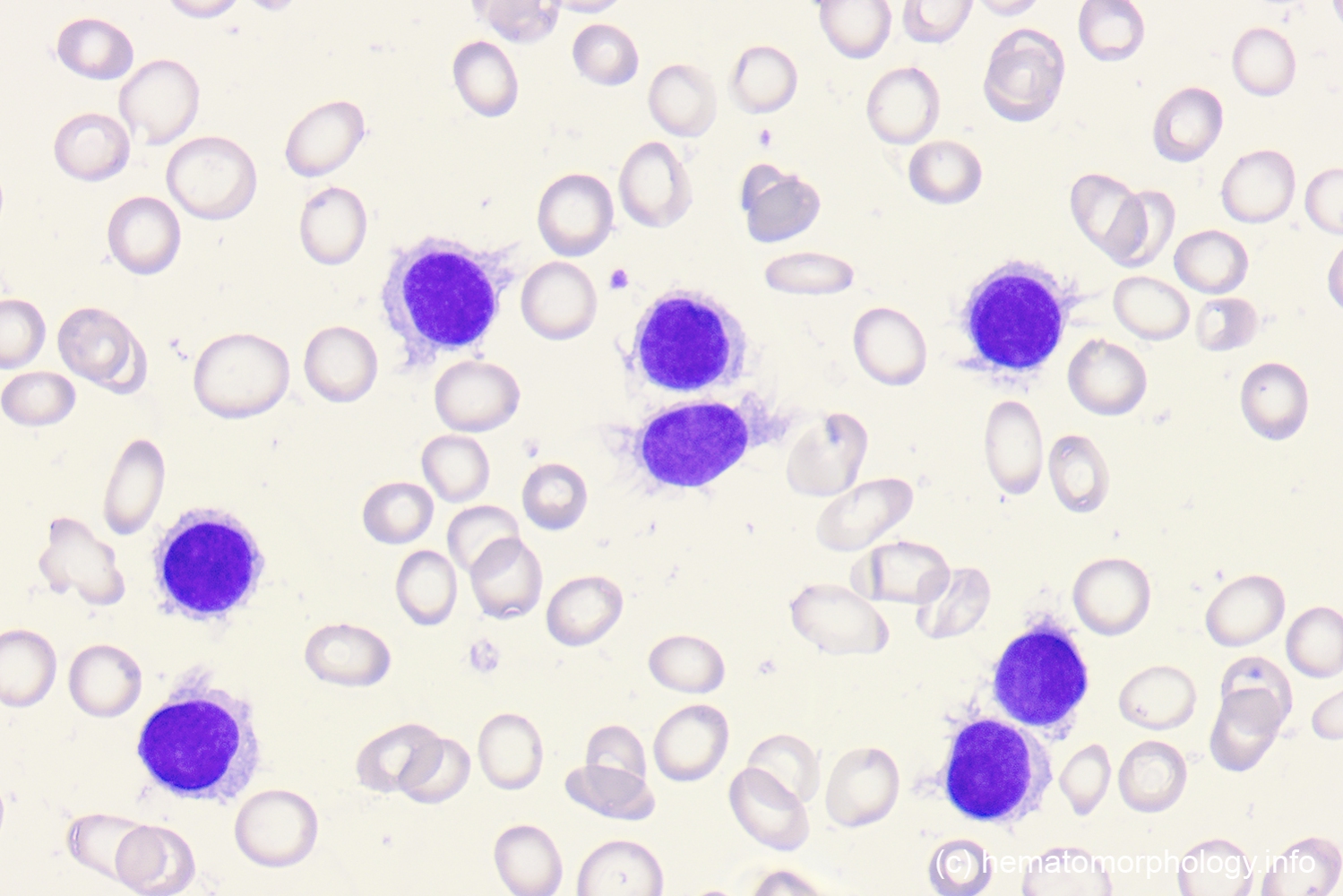 Splenic Marginal Zone Lymphoma (SMZL) - Hematomorphology, a databank ...