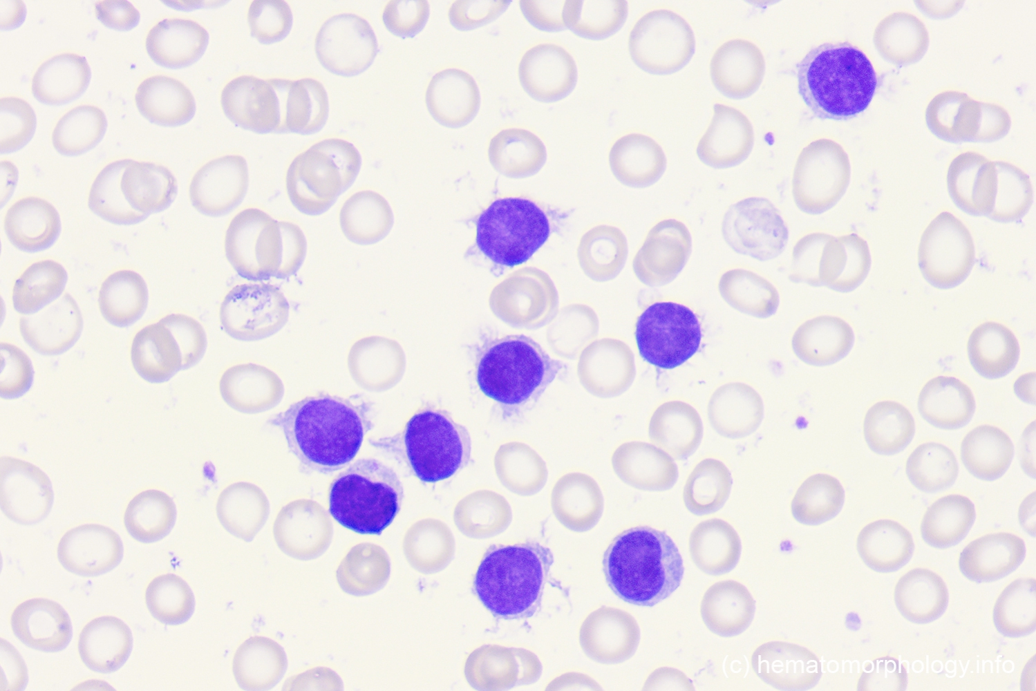 Splenic Marginal Zone Lymphoma (SMZL) - Hematomorphology, a databank ...