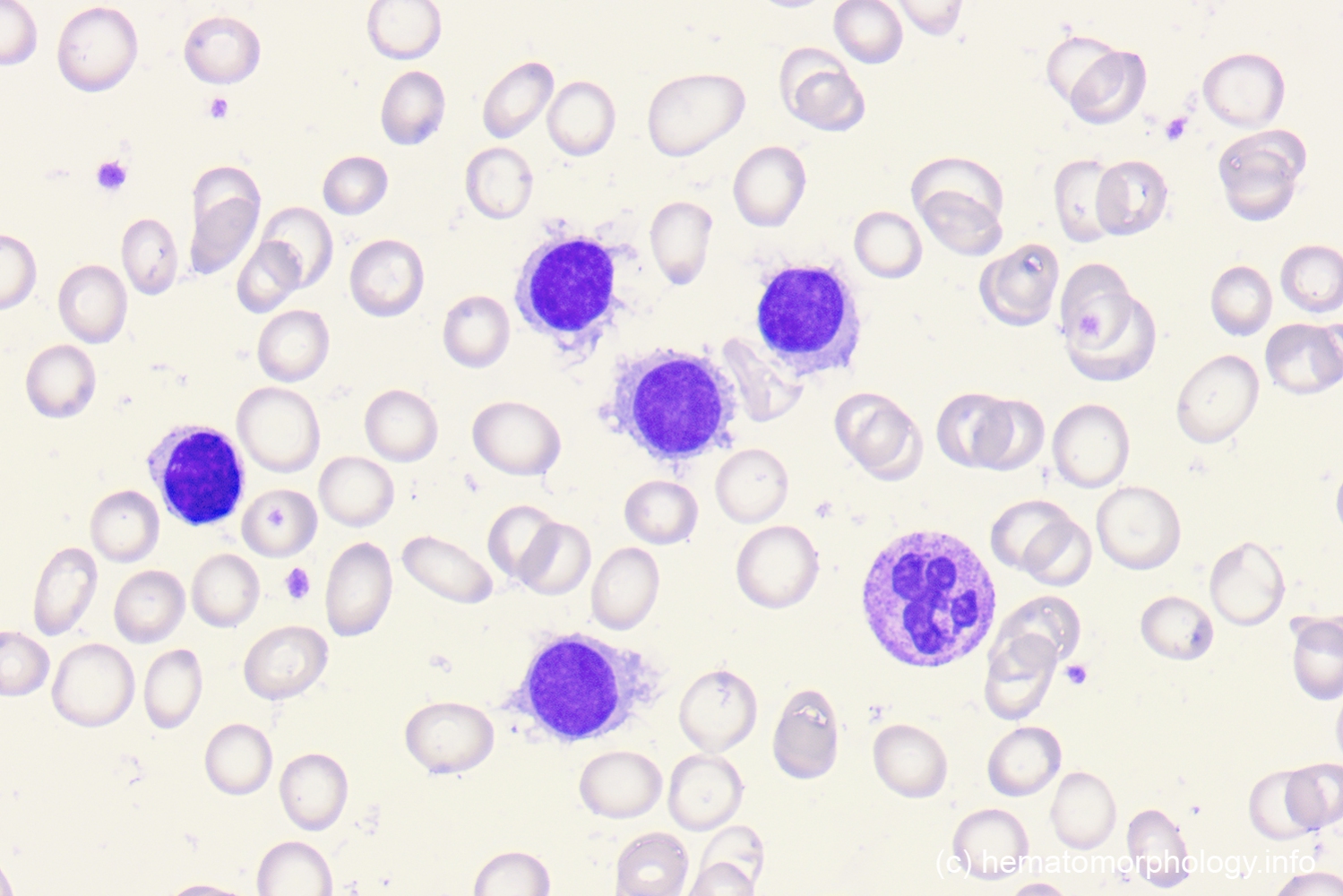 Splenic Marginal Zone Lymphoma (SMZL) - Hematomorphology, a databank ...