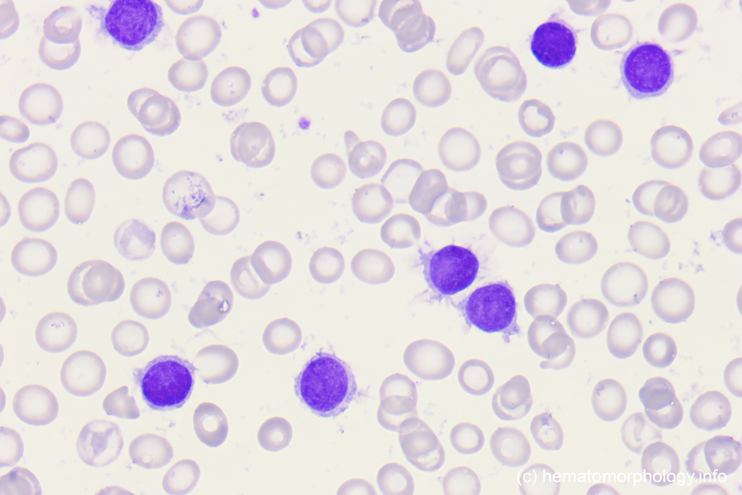 Splenic Marginal Zone Lymphoma (SMZL) - Hematomorphology, a databank ...