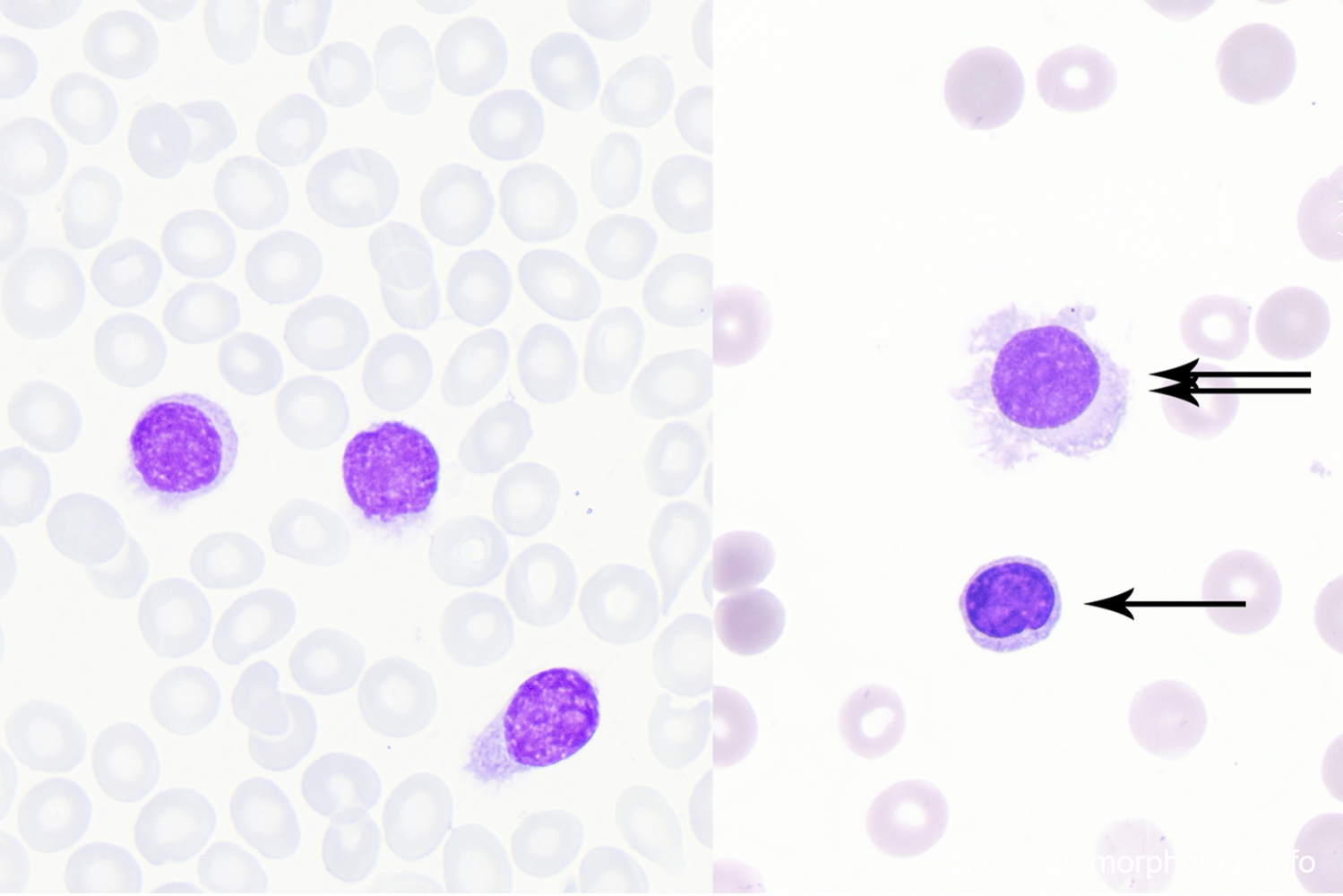 Splenic Marginal Zone Lymphoma (SMZL) - Hematomorphology, a databank ...