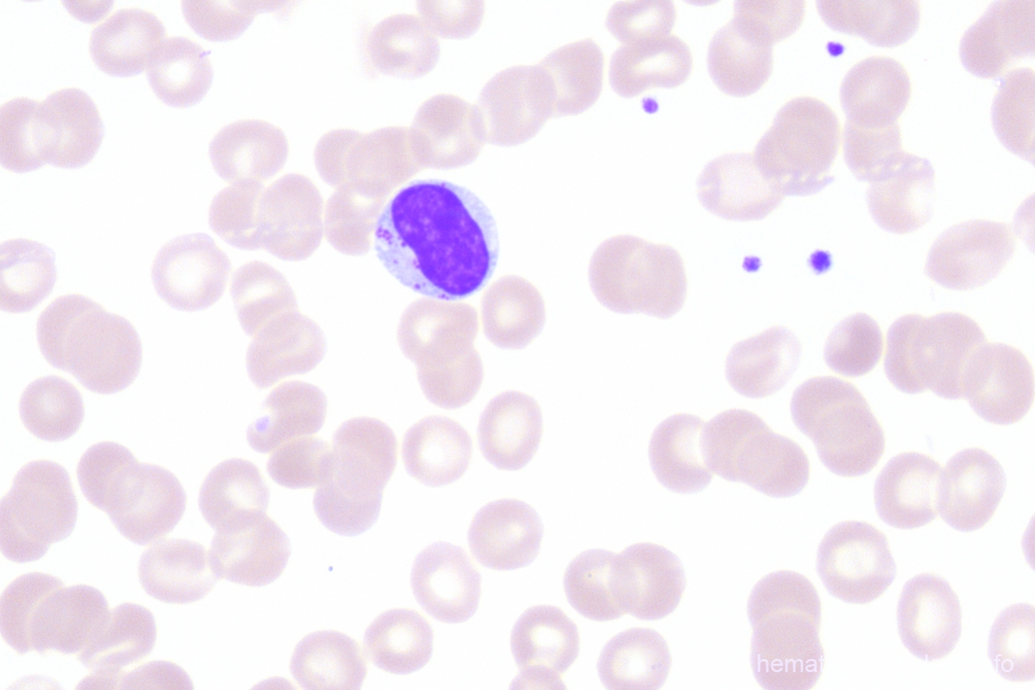 T-cell Large Granular Lymphocyic leukemia (T-LGL) - Hematomorphology, a ...