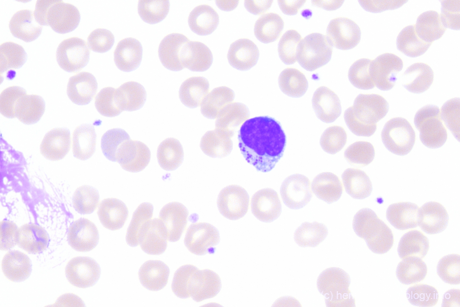 T-cell Large Granular Lymphocyic leukemia (T-LGL) - Hematomorphology, a ...