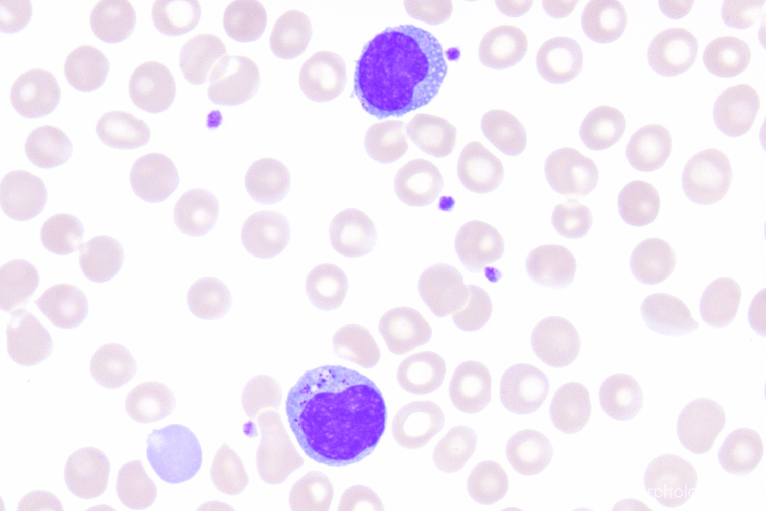 T-cell Large Granular Lymphocyic leukemia (T-LGL) - Hematomorphology, a ...