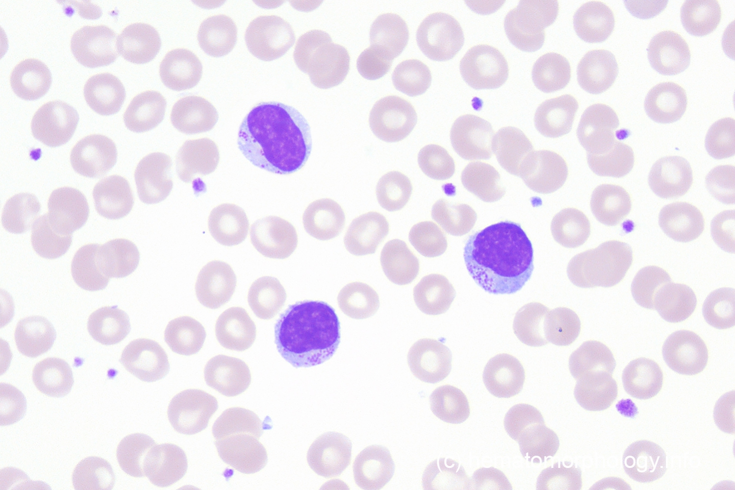 T-cell Large Granular Lymphocyic leukemia (T-LGL) - Hematomorphology, a ...