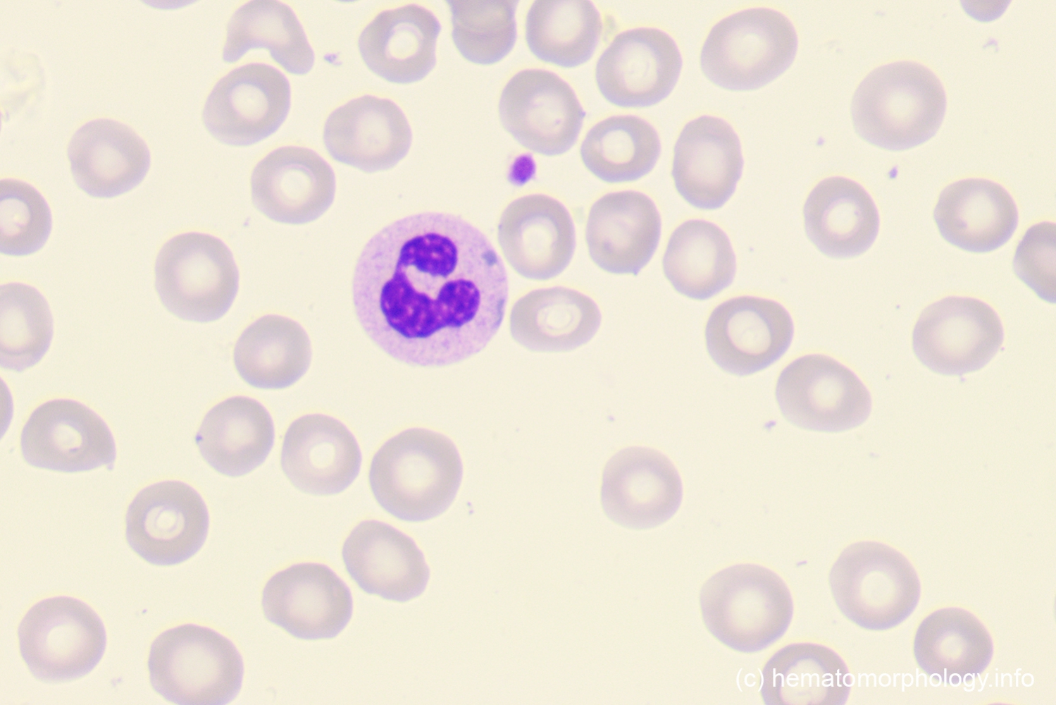 Toxic granulation & Döhle inclusion bodies - Hematomorphology, a ...