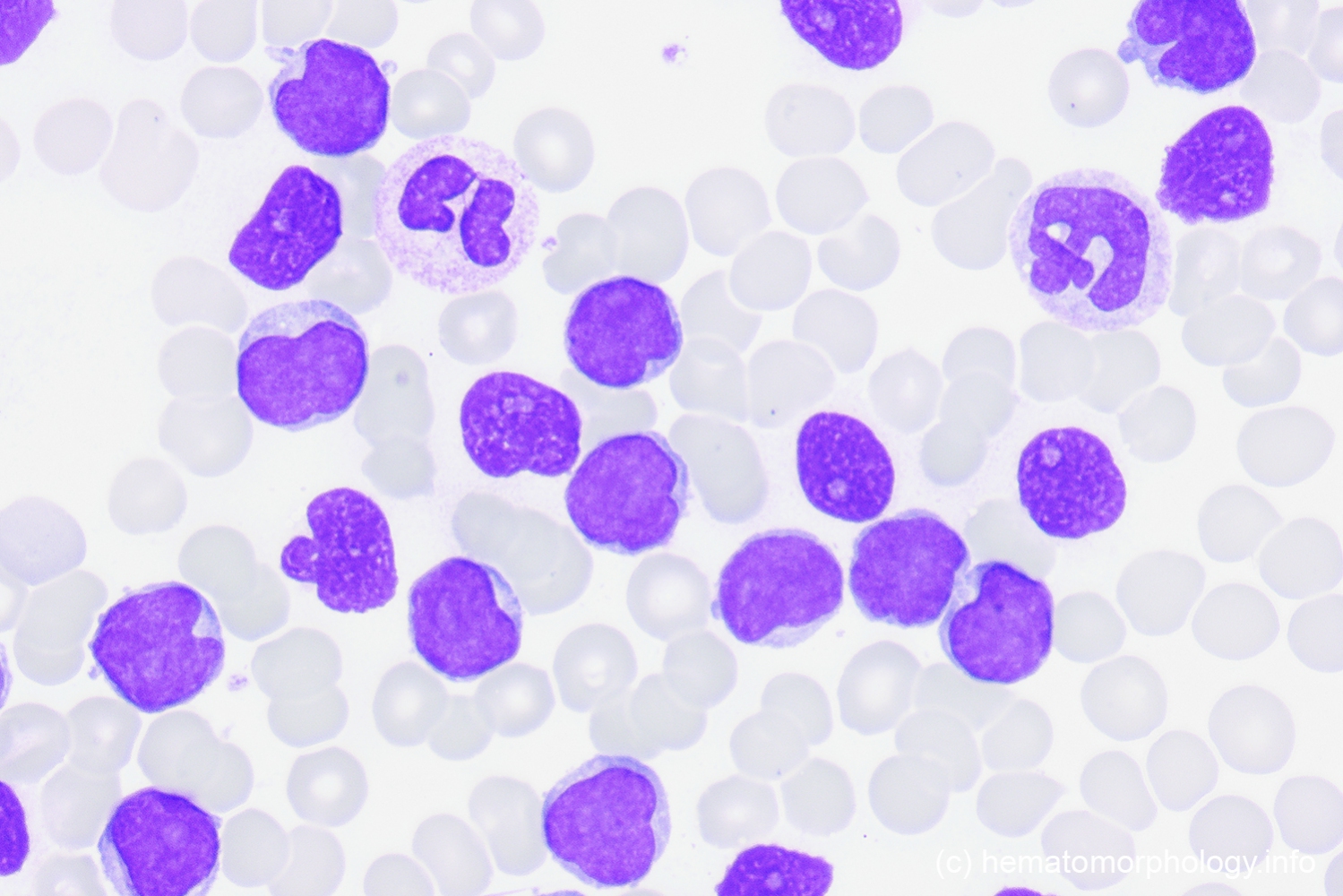 T-cell ProLymphocytic Leukemia (T-PLL) - Hematomorphology, a databank ...