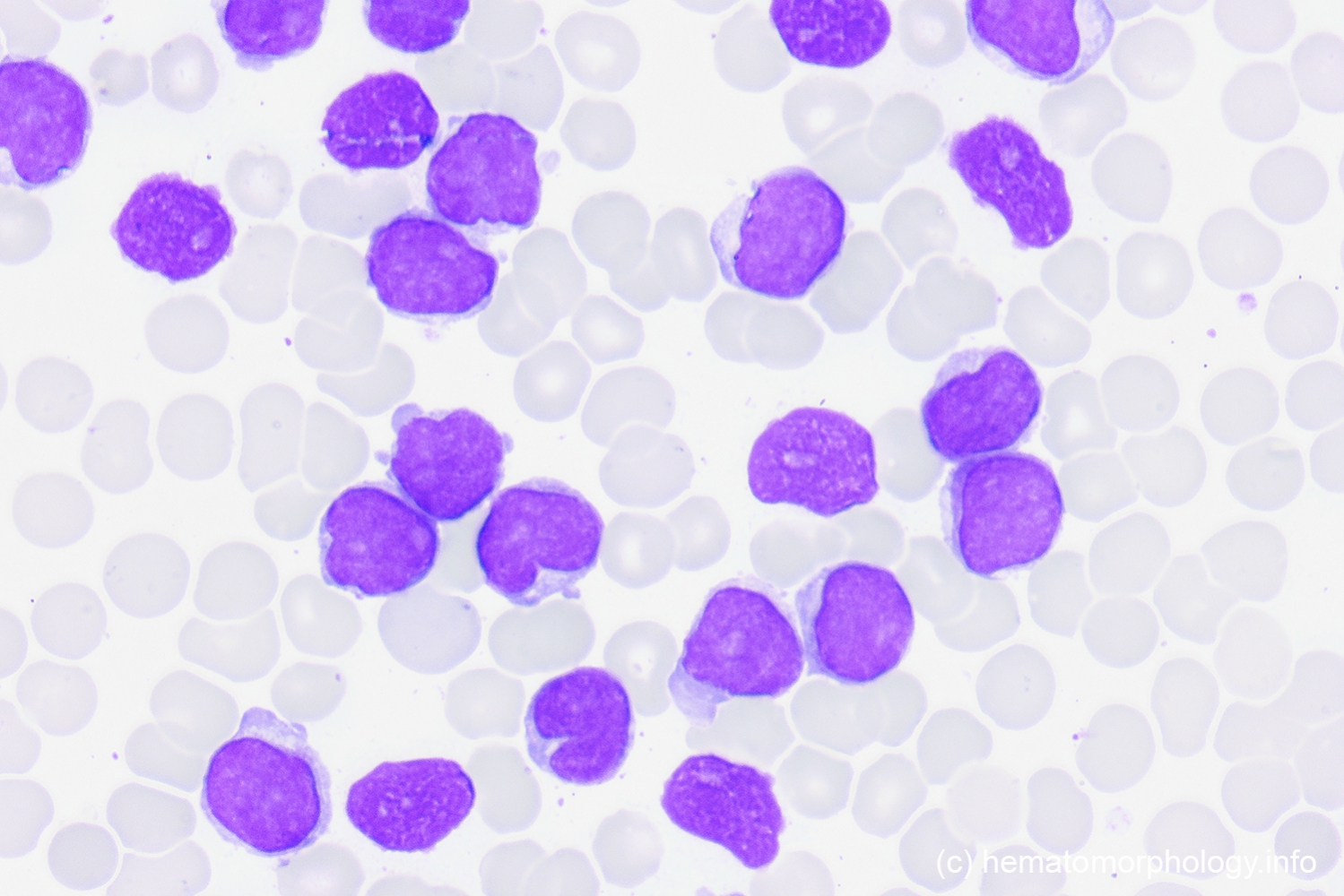 T-cell ProLymphocytic Leukemia (T-PLL) - Hematomorphology, a databank ...